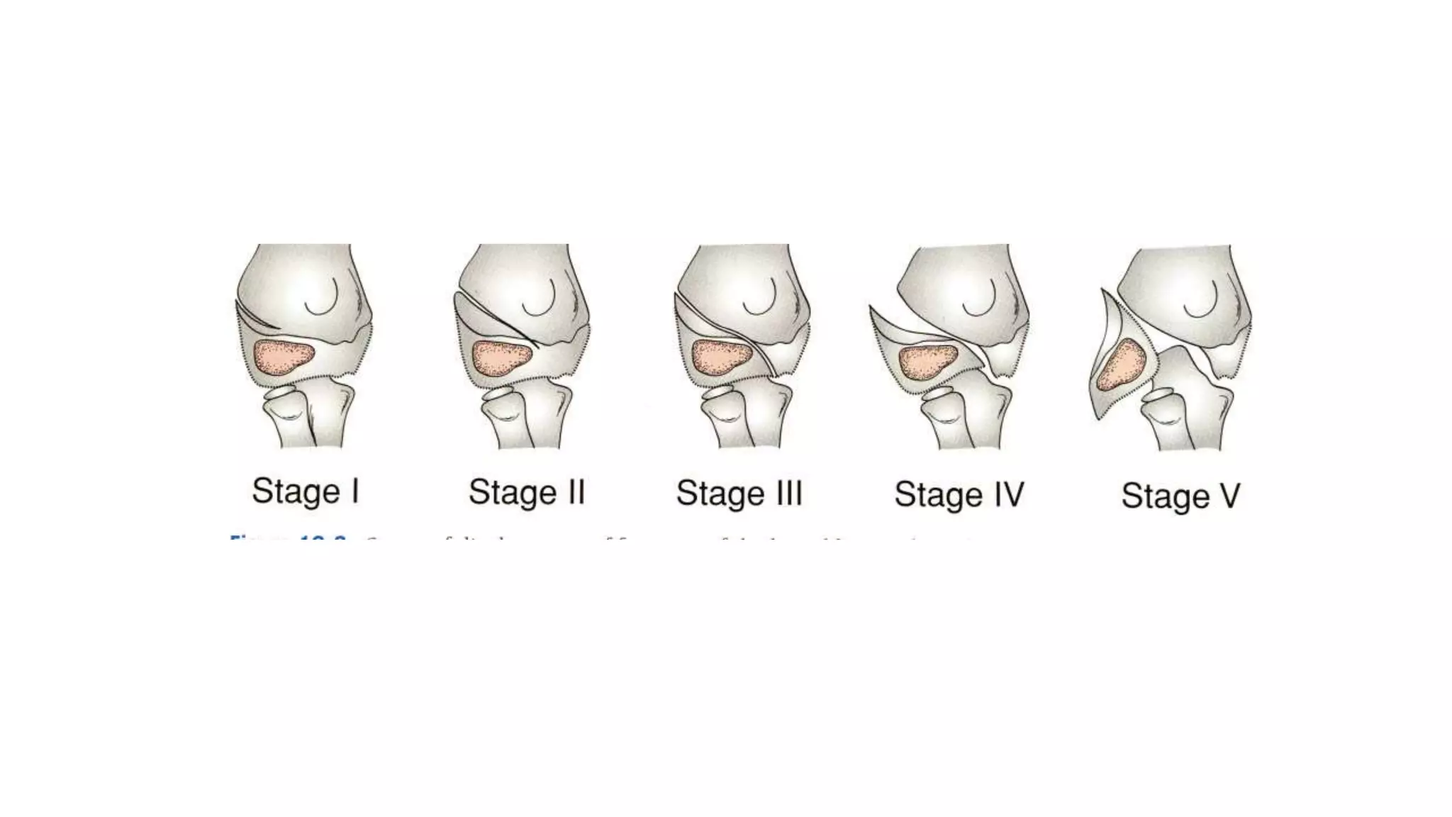 Lateral condylar fractures of the distal humerus | PPTX
