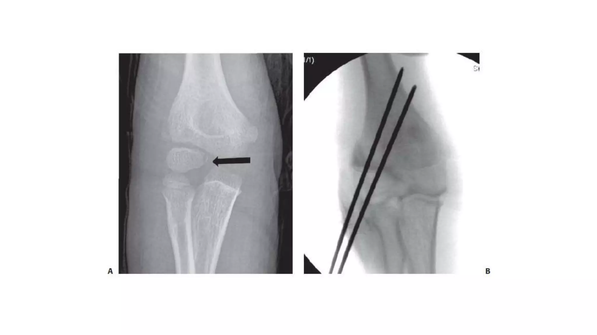 Lateral condylar fractures of the distal humerus | PPTX