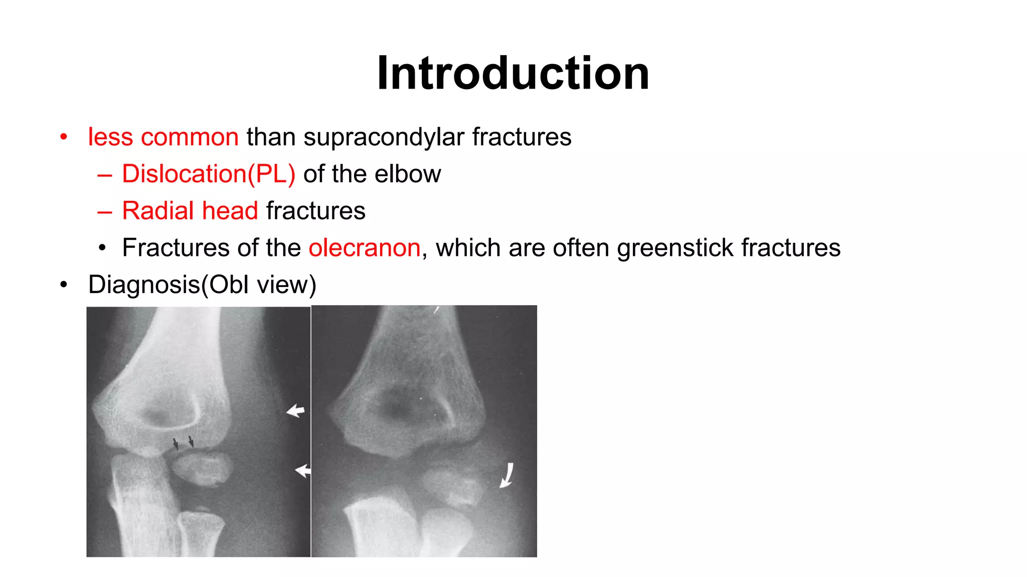 Lateral condylar fractures of the distal humerus | PPTX