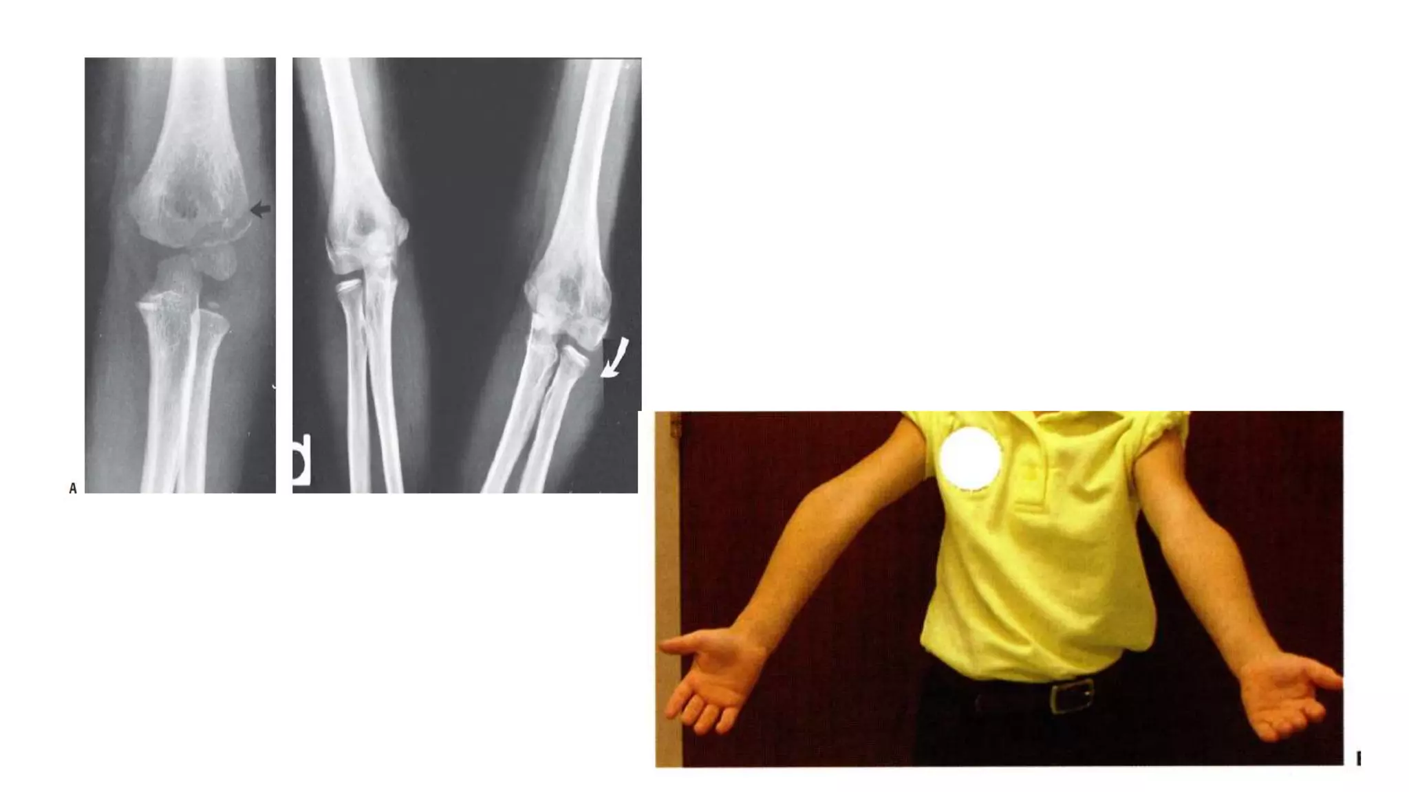 Lateral condylar fractures of the distal humerus | PPTX