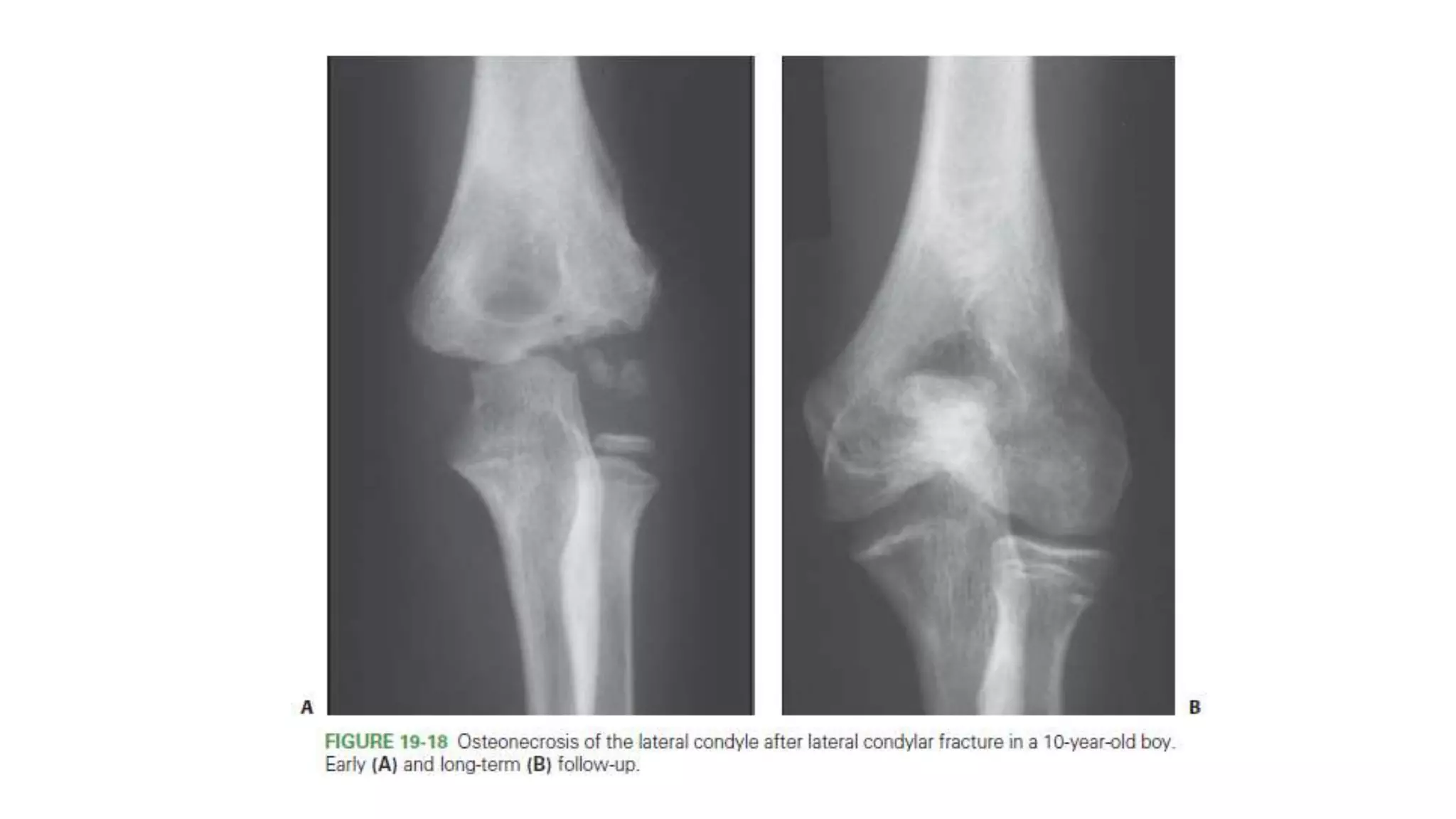 Lateral condylar fractures of the distal humerus | PPTX