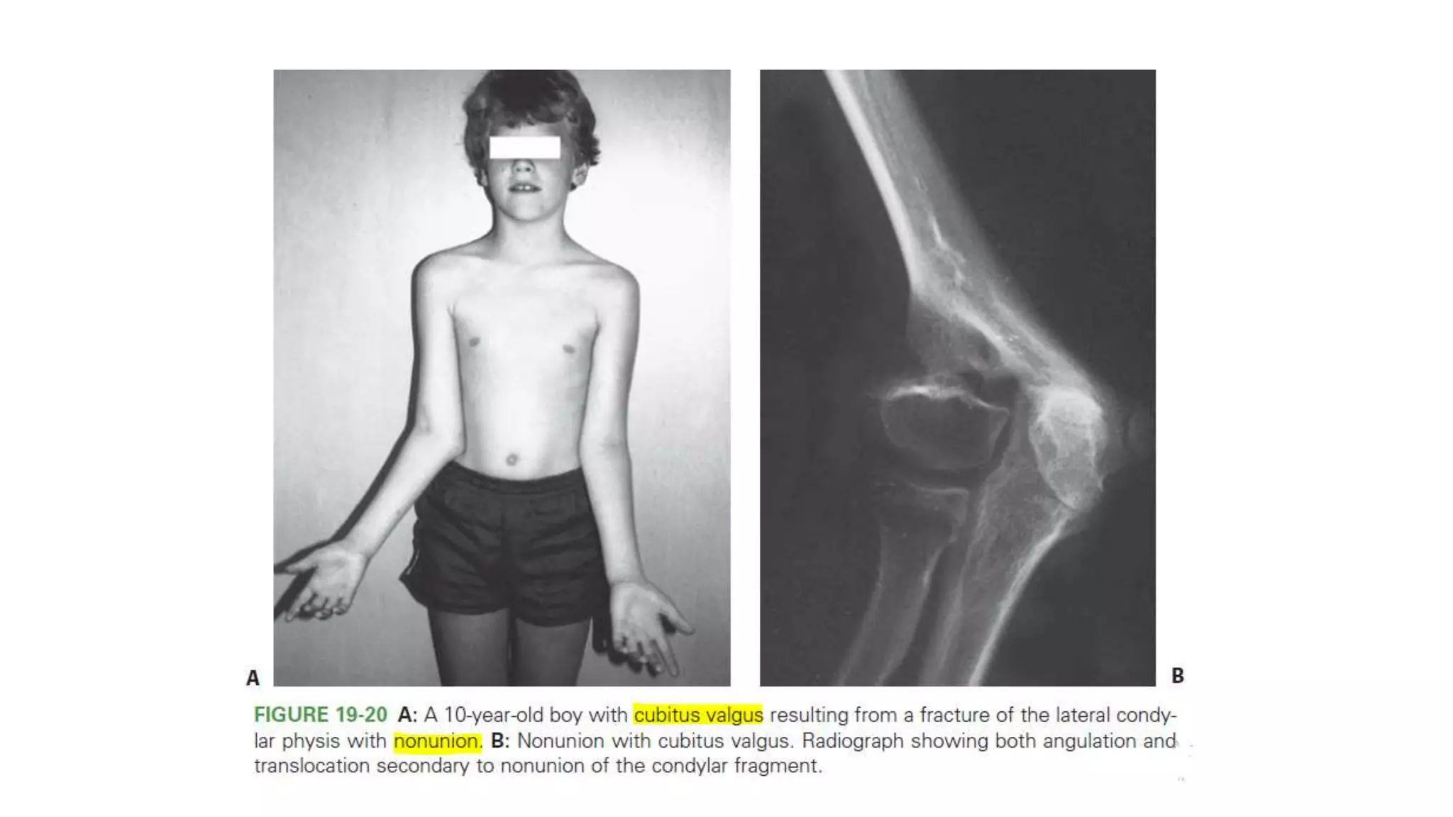 Lateral condylar fractures of the distal humerus | PPTX
