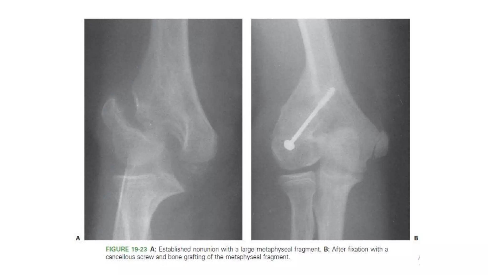 Lateral condylar fractures of the distal humerus | PPTX