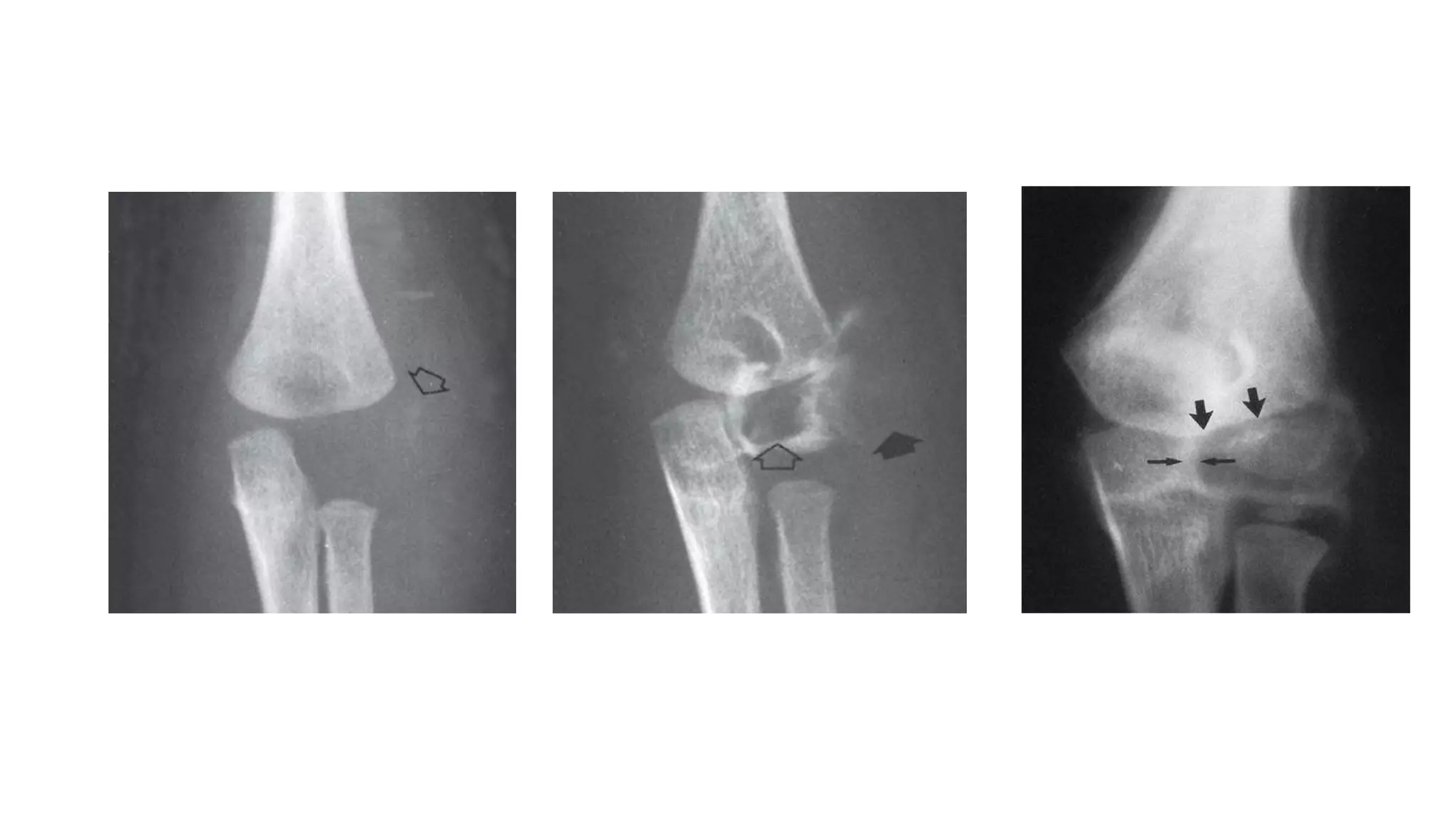 Lateral condylar fractures of the distal humerus | PPTX