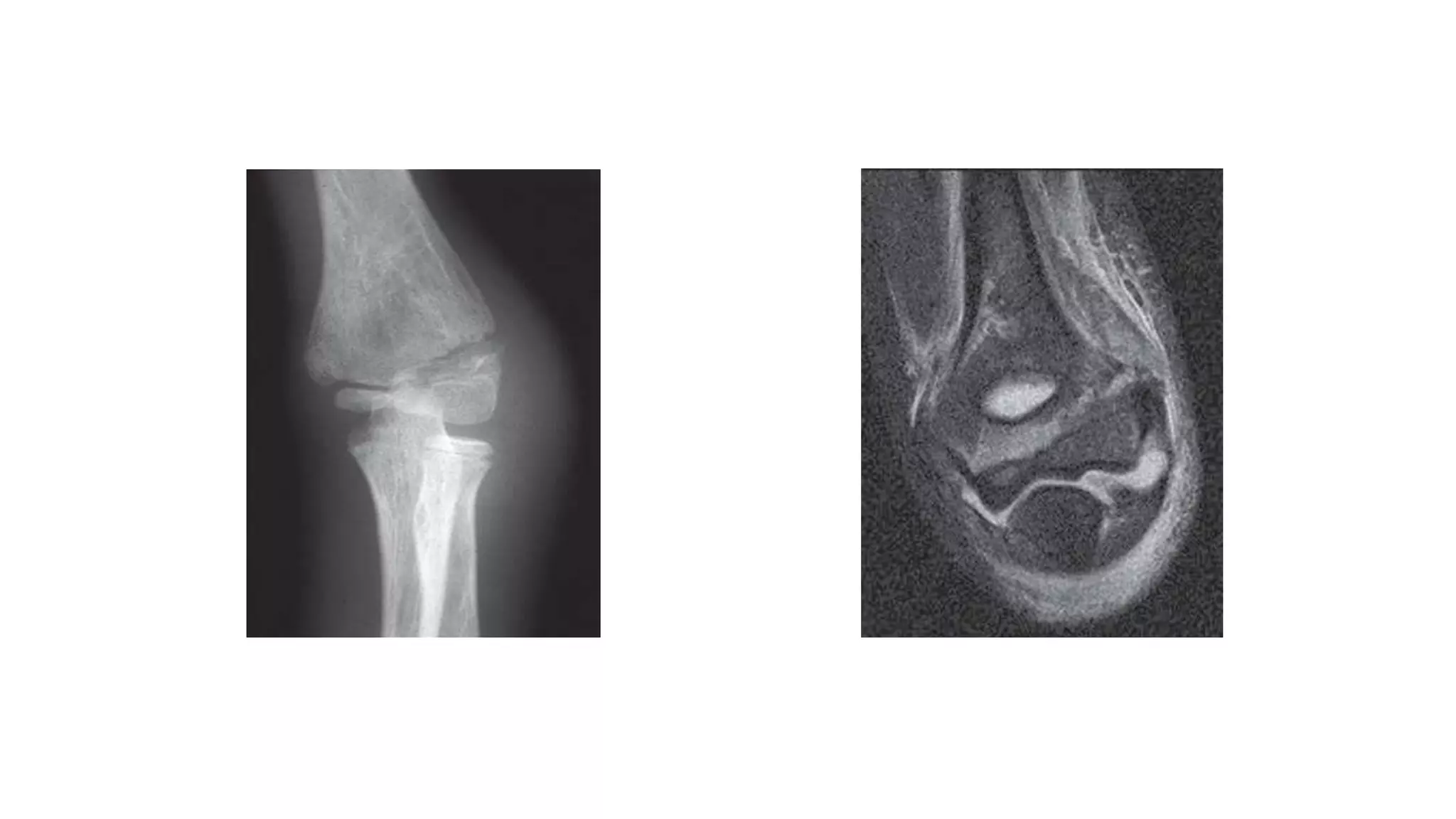 Lateral condylar fractures of the distal humerus | PPTX