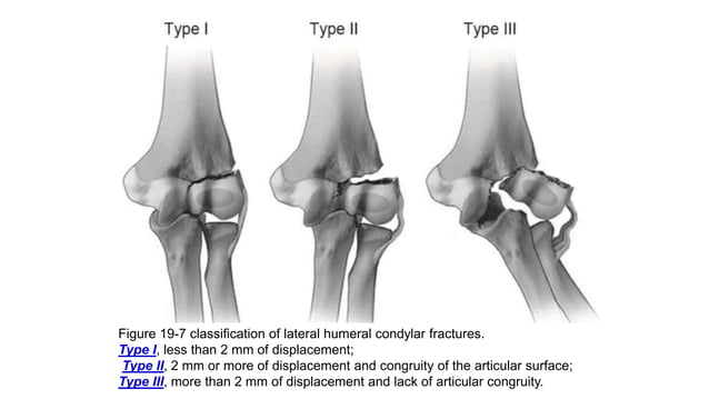 Lateral condylar fractures of the distal humerus | PPTX | Death, Injury ...