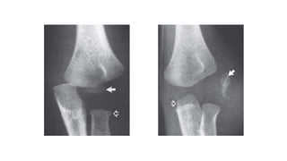 Lateral condylar fractures of the distal humerus | PPTX