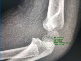 Lateral condyle.pptx