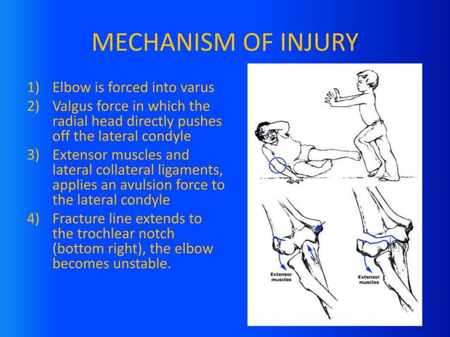 Lateral condyle.pptx