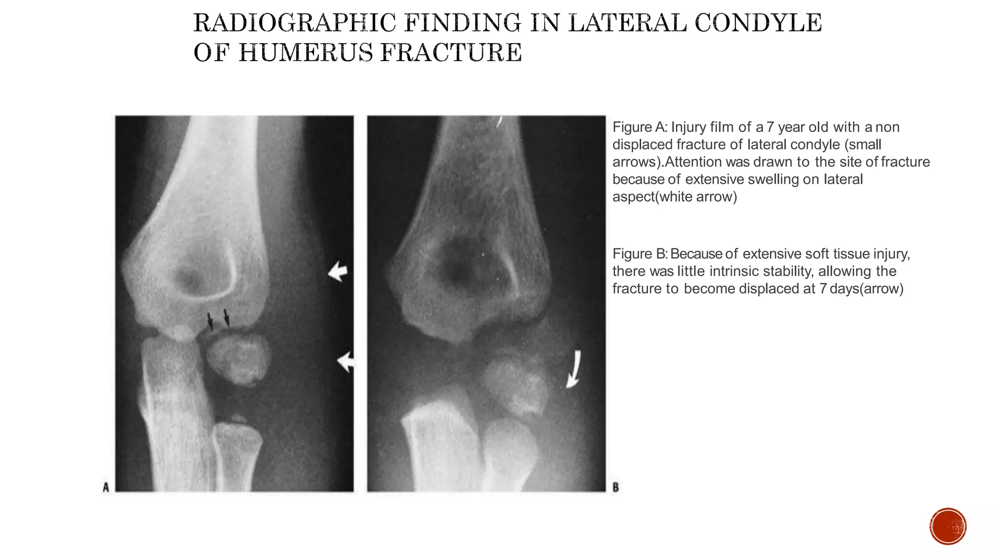 Lateral condyle fracture of humerus in children | PPTX
