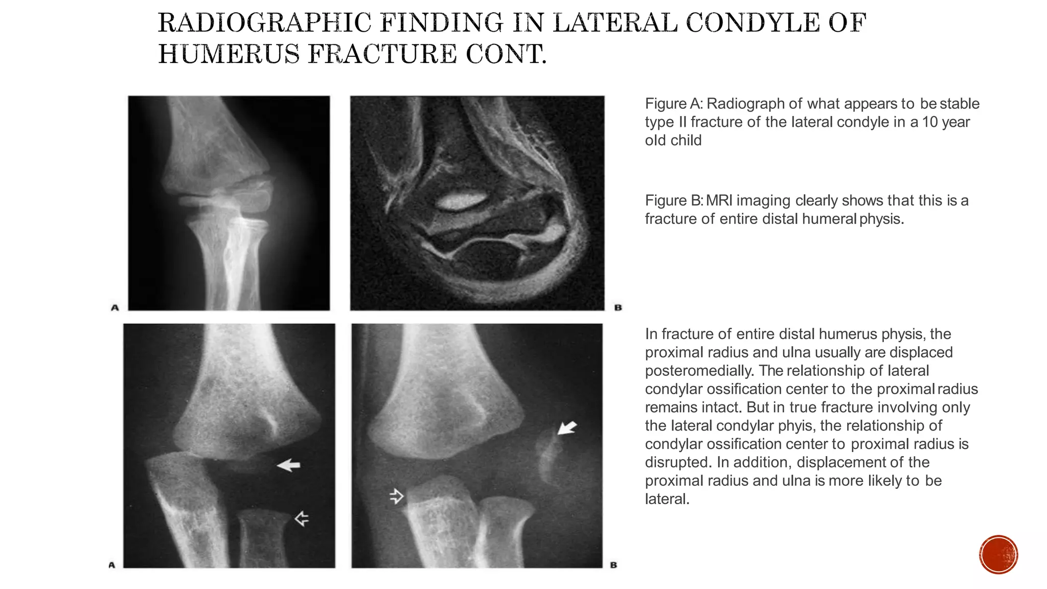 Lateral condyle fracture of humerus in children | PPTX