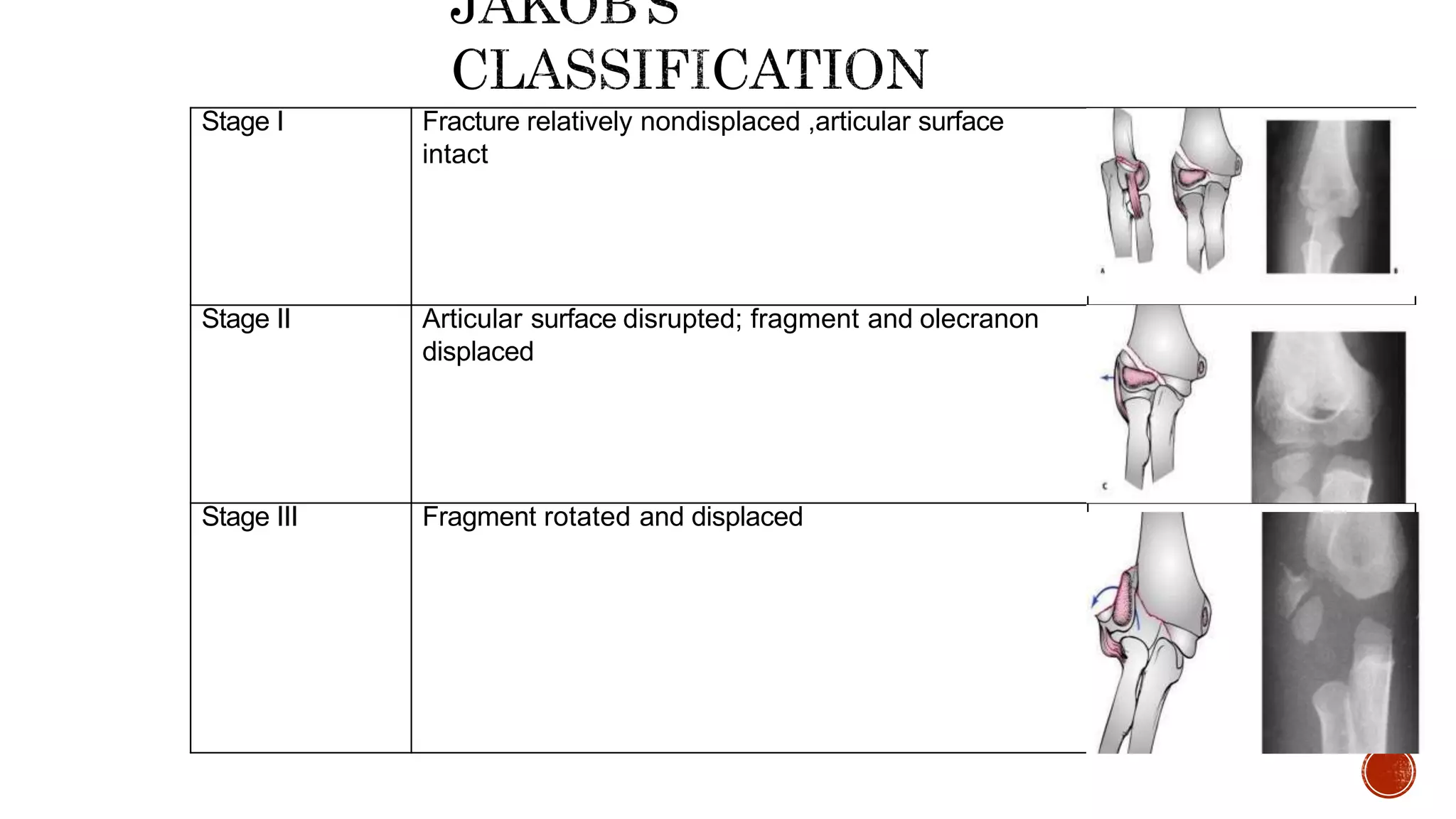 Lateral condyle fracture of humerus in children | PPTX