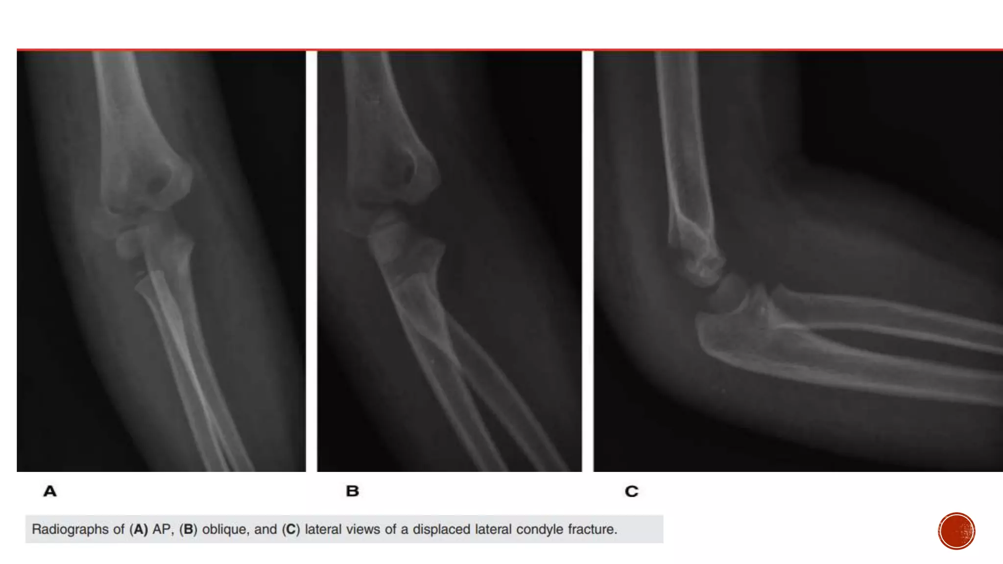 Lateral condyle fracture of humerus in children | PPTX