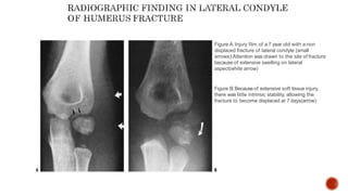 Lateral condyle fracture of humerus in children | PPTX