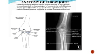 Lateral condyle fracture of humerus in children | PPTX