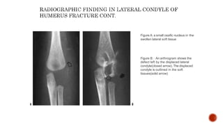 Fishtail Deformity Lateral Condyle Fracture