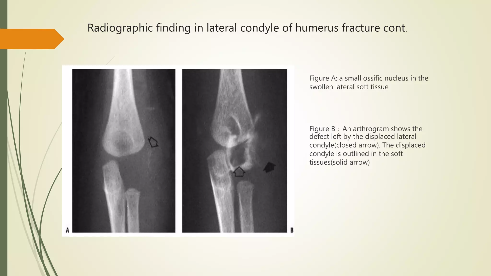 Lateral condyle of humerus fracture in children | PPTX