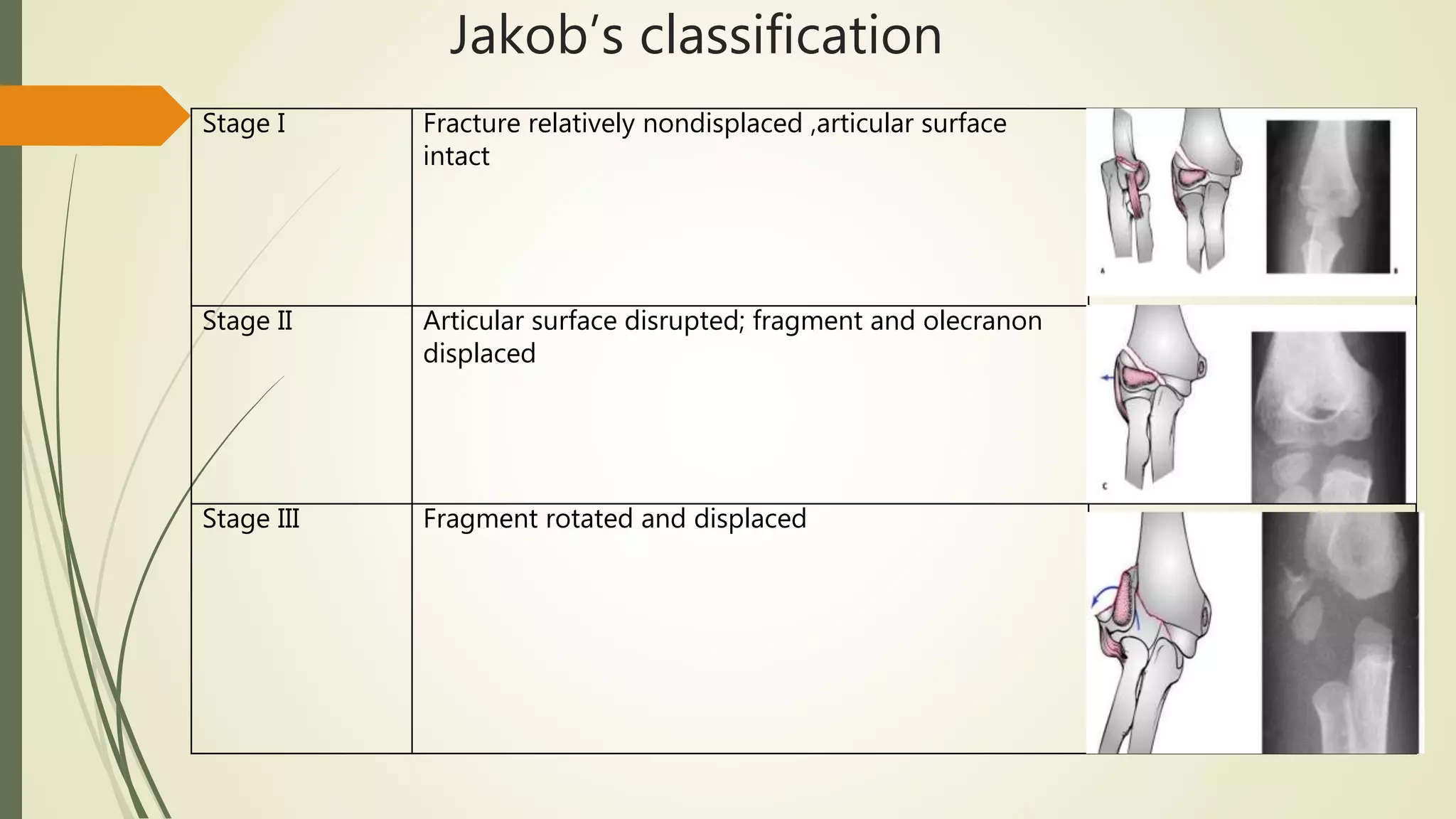Lateral condyle of humerus fracture in children | PPTX