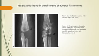 Lateral condyle of humerus fracture in children | PPTX