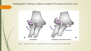 Lateral condyle of humerus fracture in children | PPTX