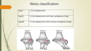 Lateral condyle of humerus fracture in children | PPTX