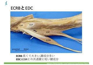 肘外側上顆炎(テニス肘) 治療など文献まとめ Lateral epicondylitis | PDF