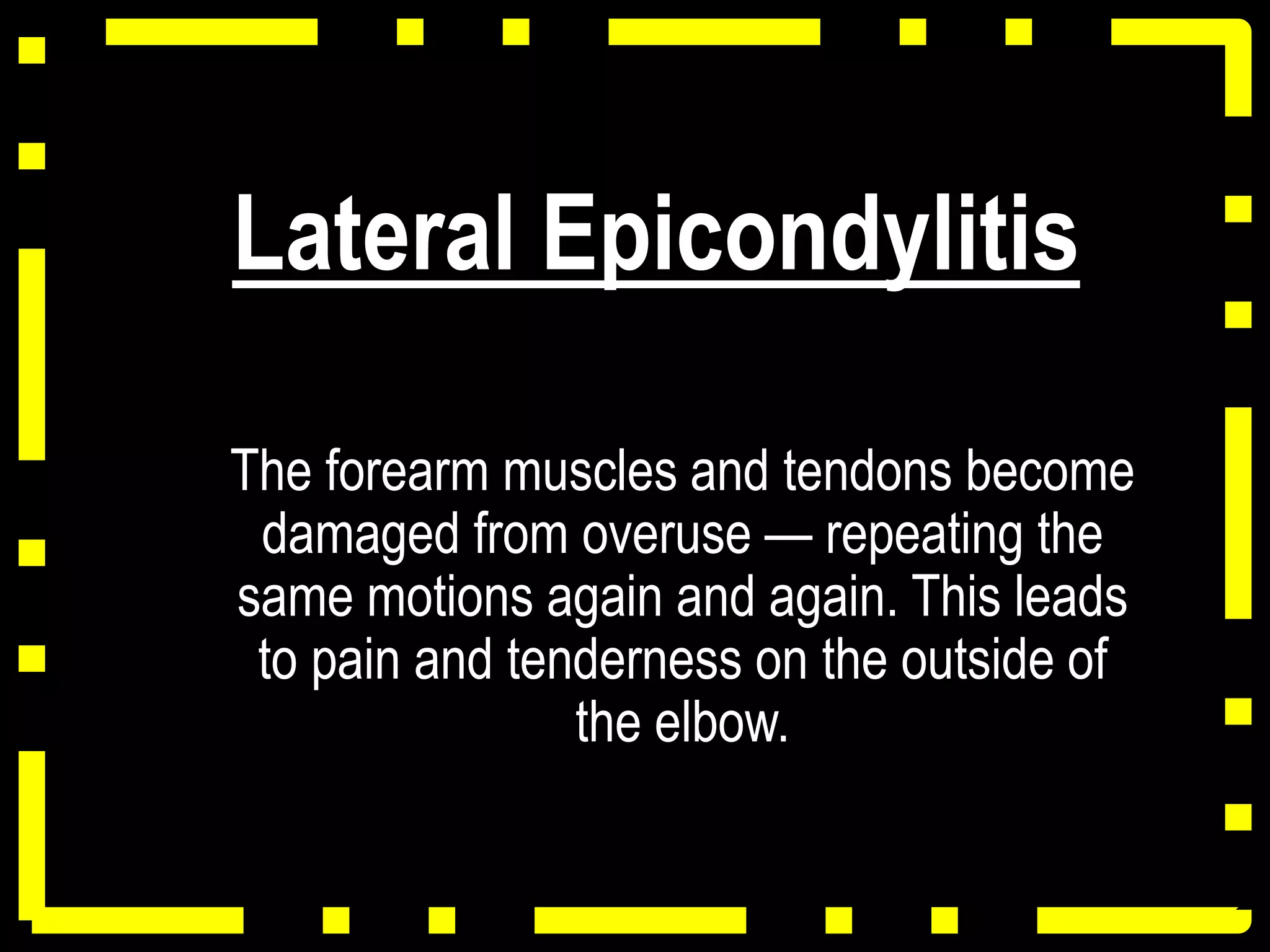 Lateral Epicondylitis | PPTX