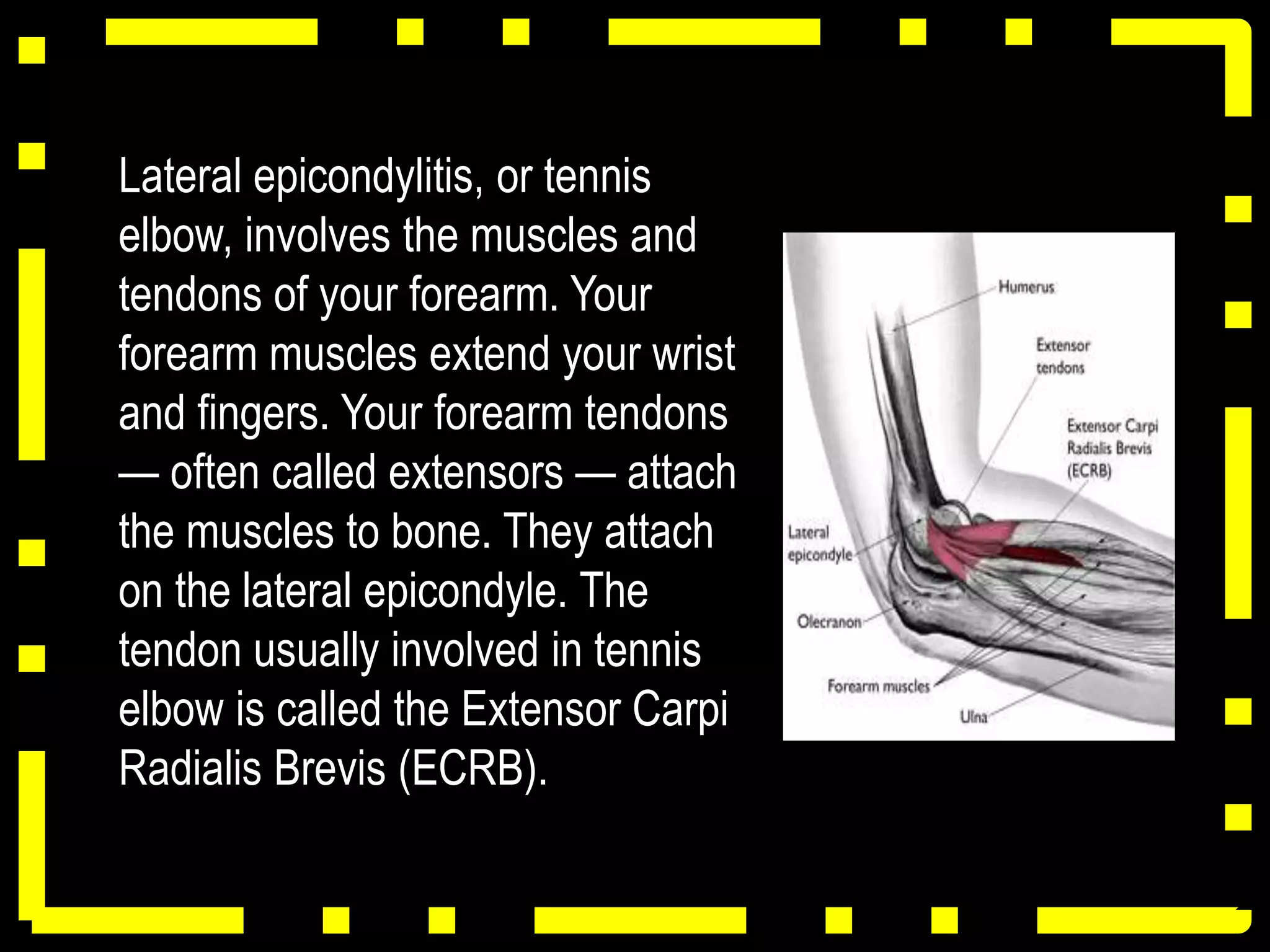 Lateral Epicondylitis | PPTX
