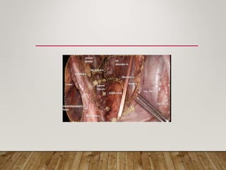 lateral lymph node dissection.pptx | Cancer | Diseases and Conditions