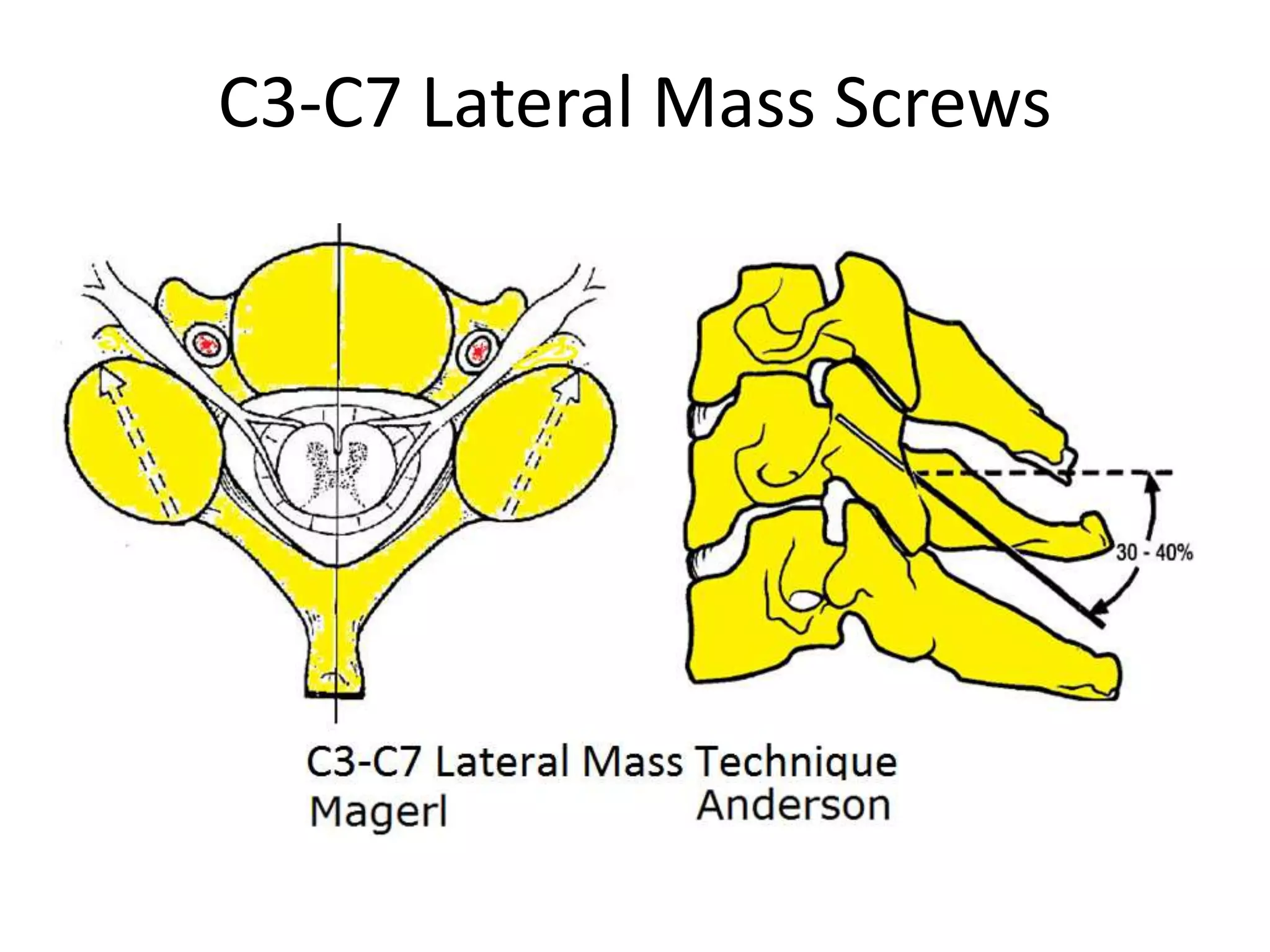 Lateral mass screws | PPSX