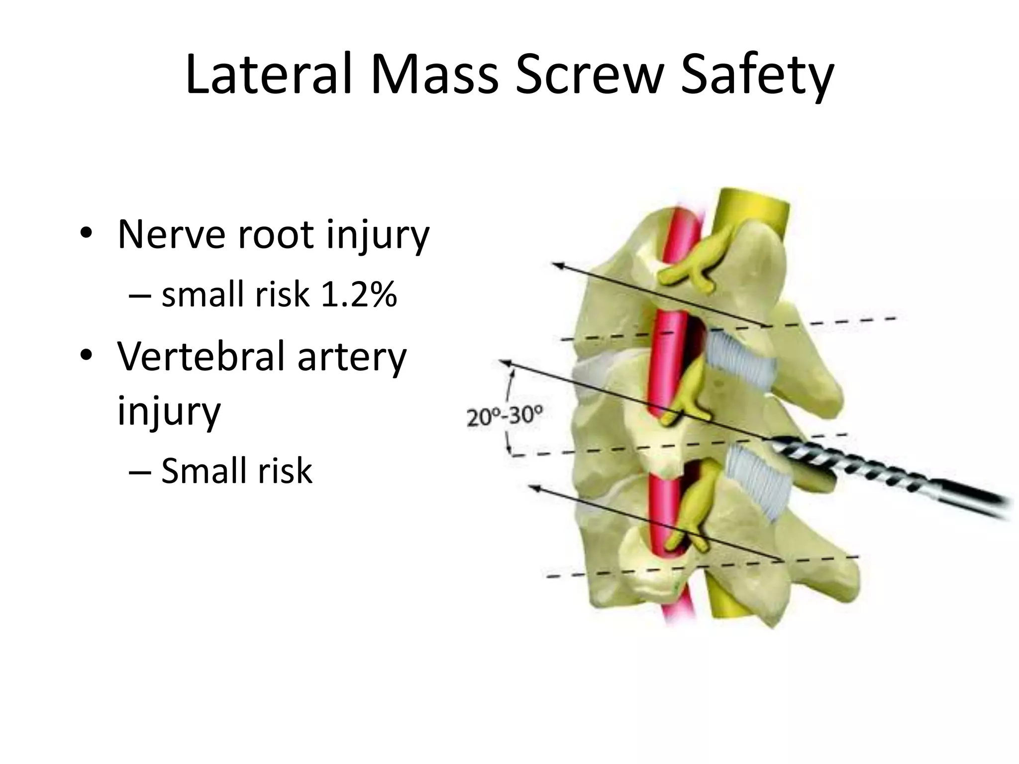 Lateral mass screws | PPSX