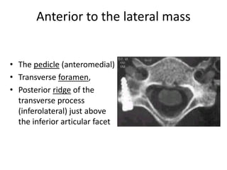 Lateral mass screws | PPSX