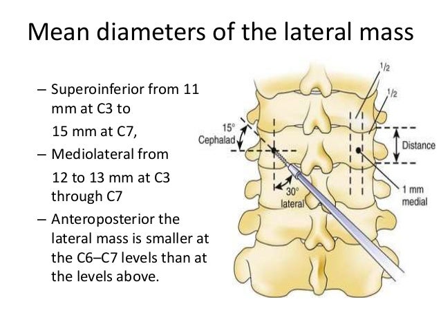 Lateral Mass Screws