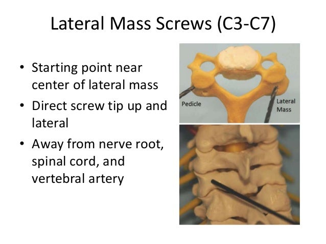 Lateral mass screws