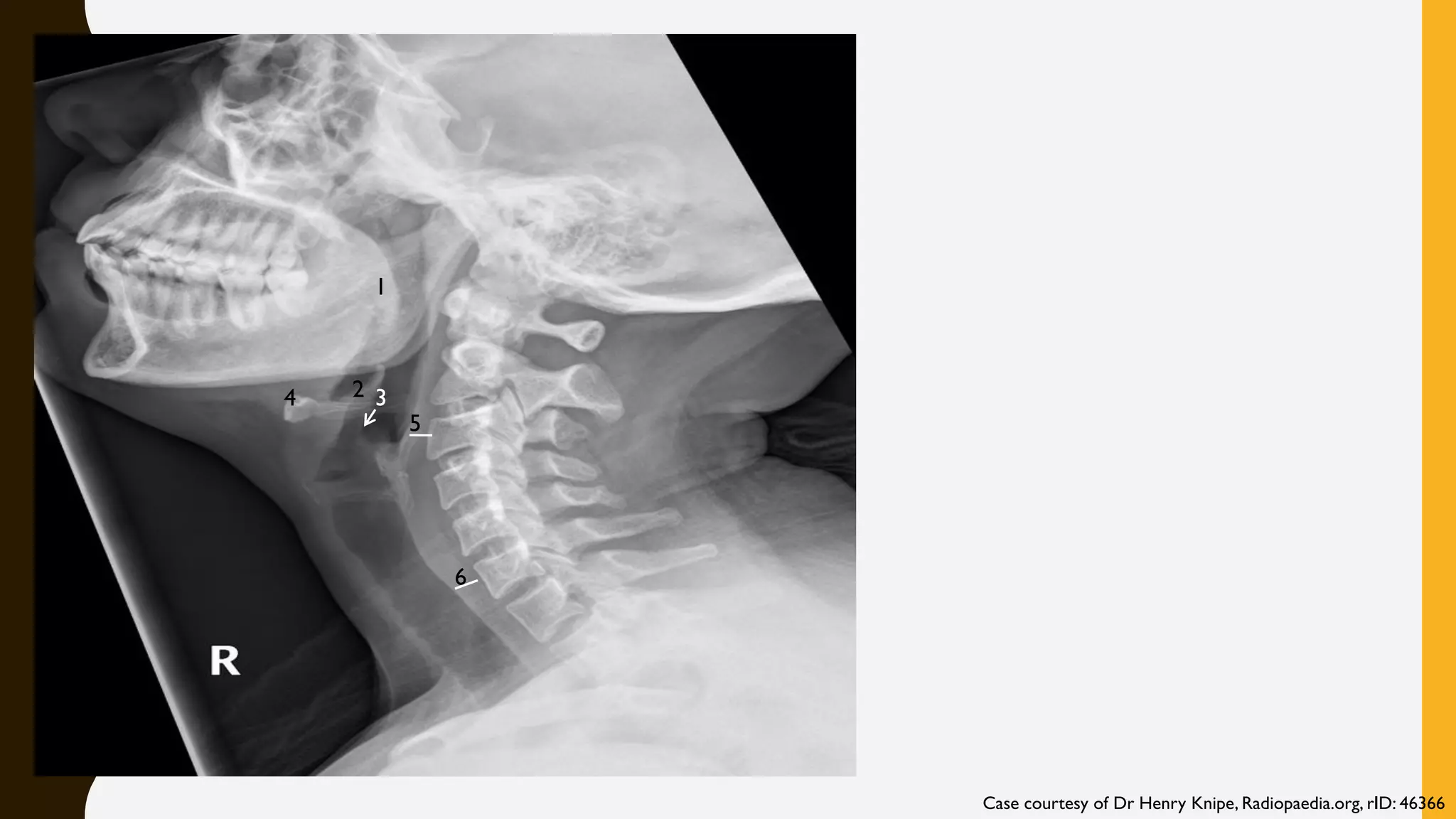 Lateral neck radiographs | PDF