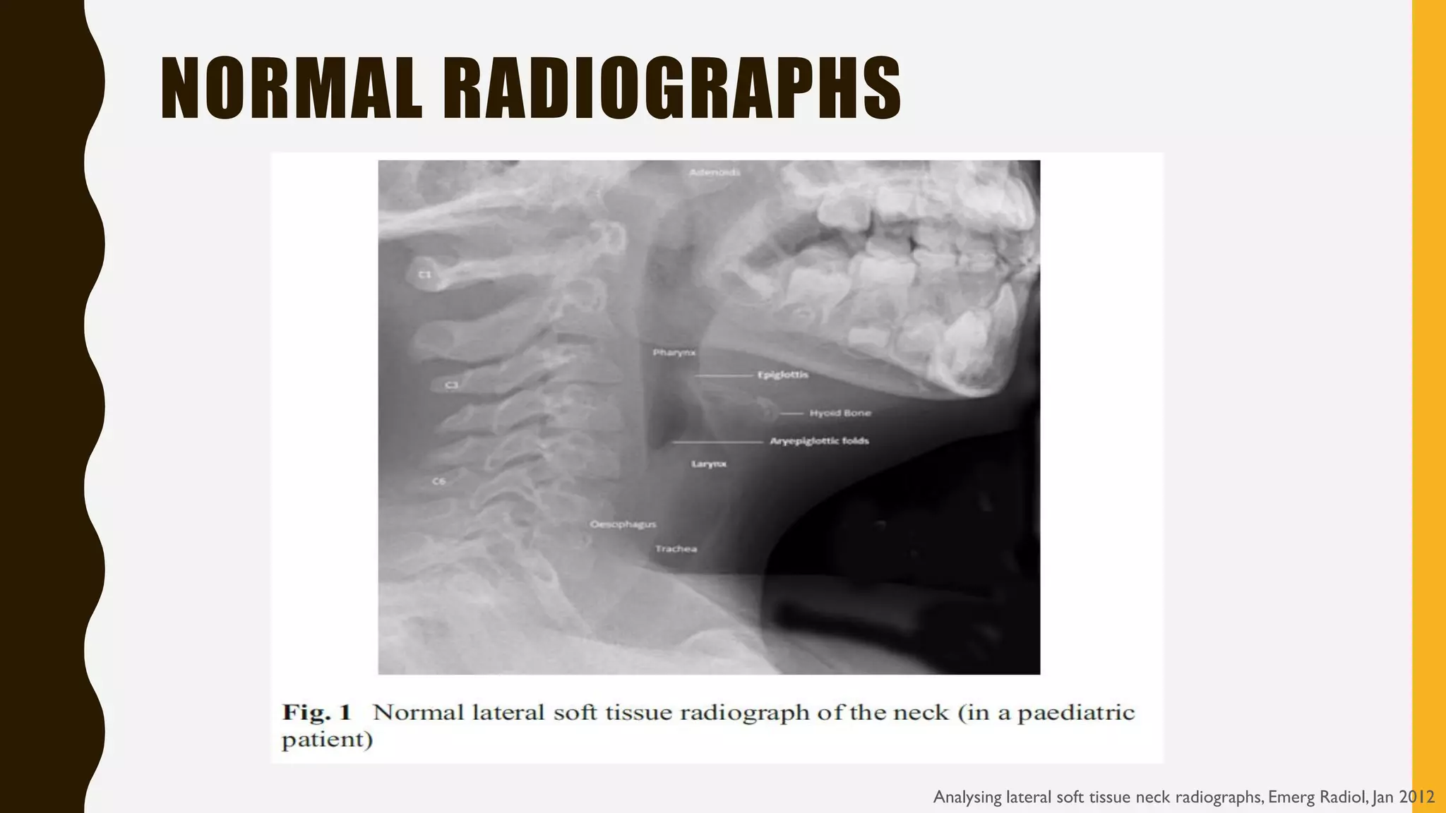 Lateral neck radiographs | PDF