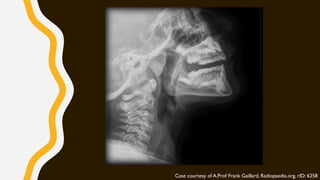 Lateral neck radiographs | PDF