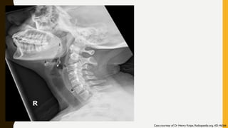 Lateral neck radiographs | PDF
