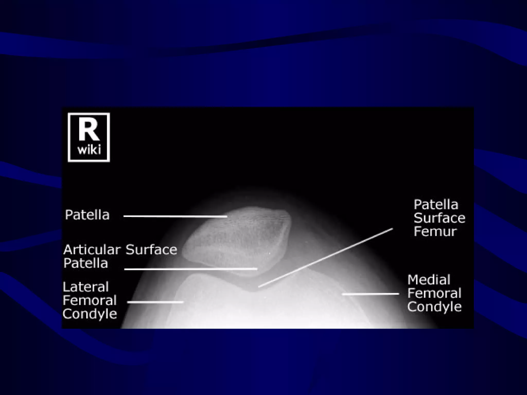 Lateral patellar compression syndrome | PPT
