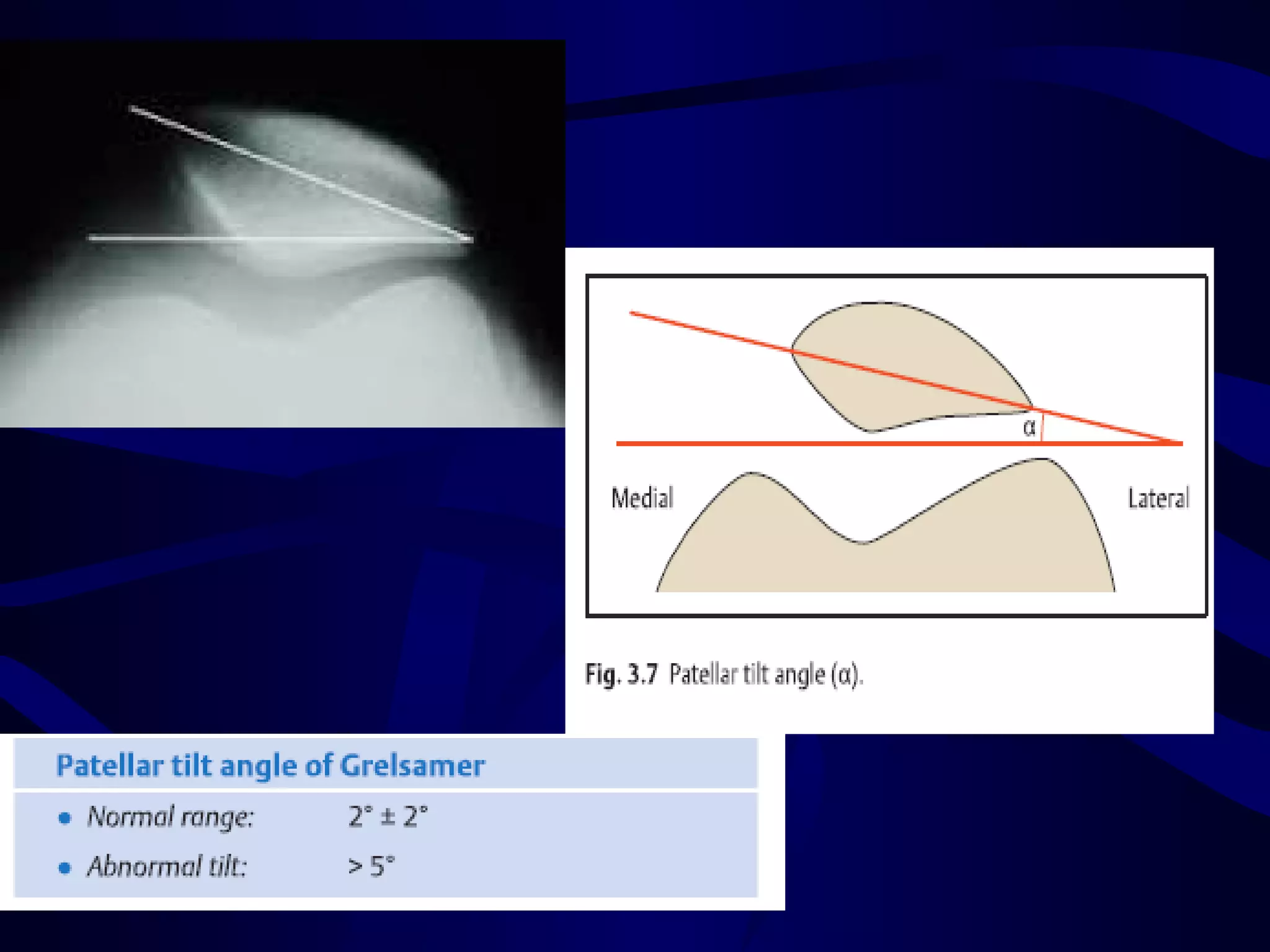 Lateral patellar compression syndrome | PPT