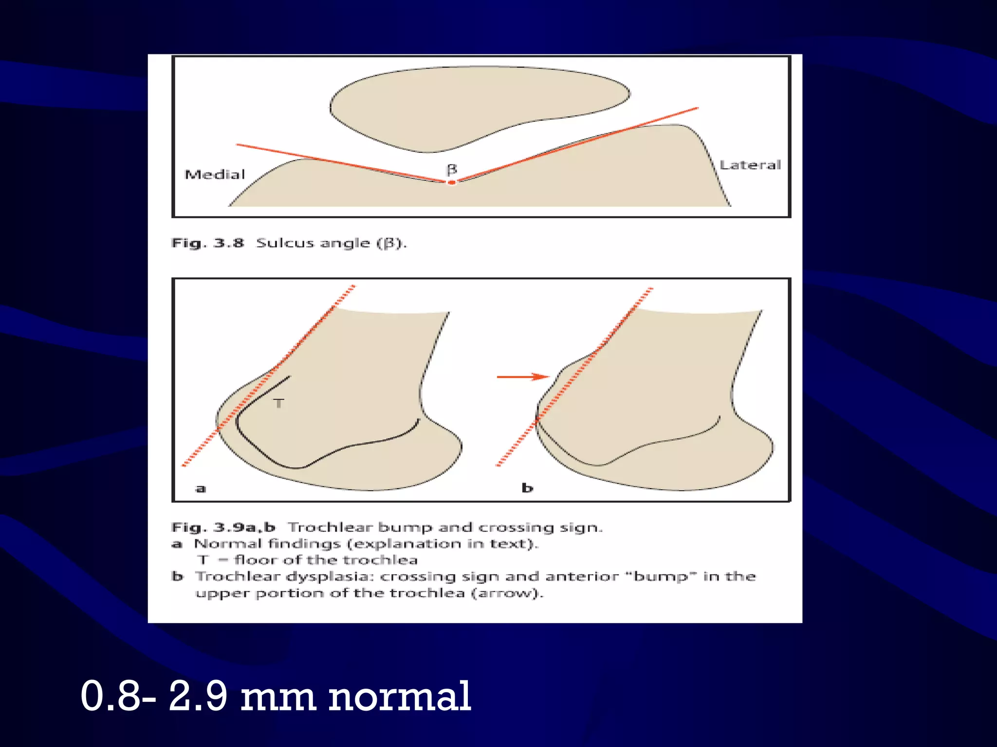 Lateral patellar compression syndrome | PPT