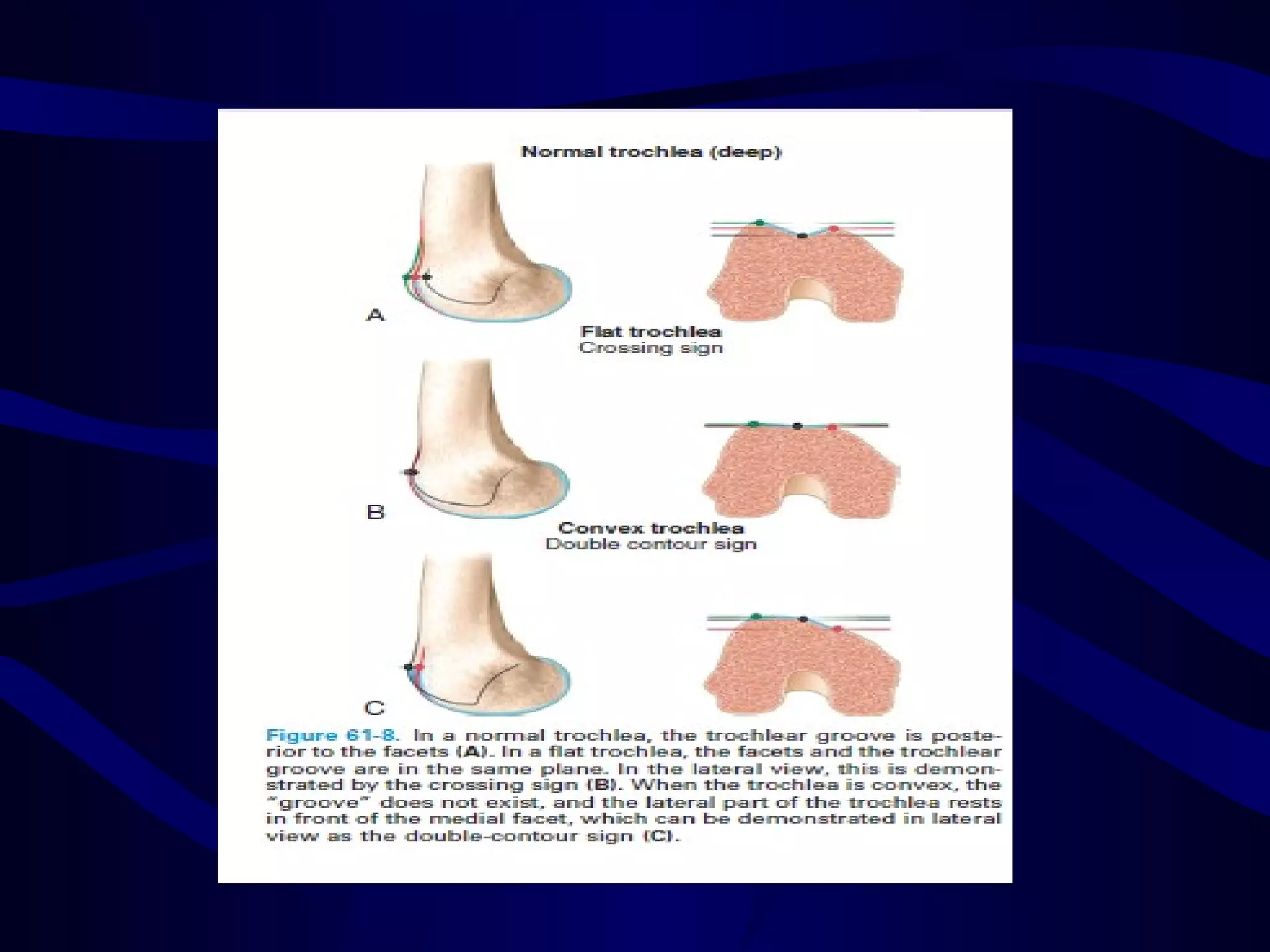 Lateral patellar compression syndrome | PPT