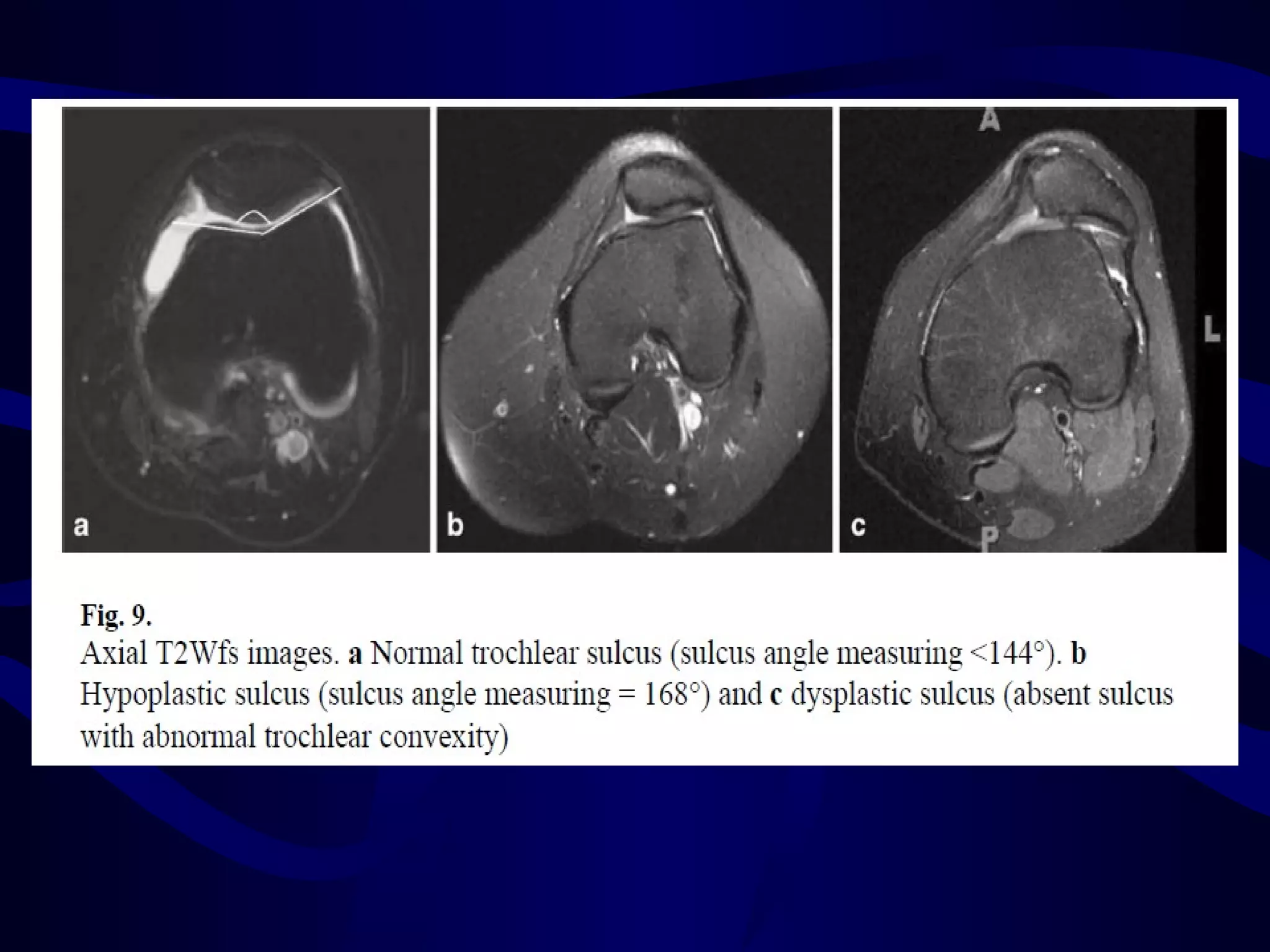 Lateral patellar compression syndrome | PPT