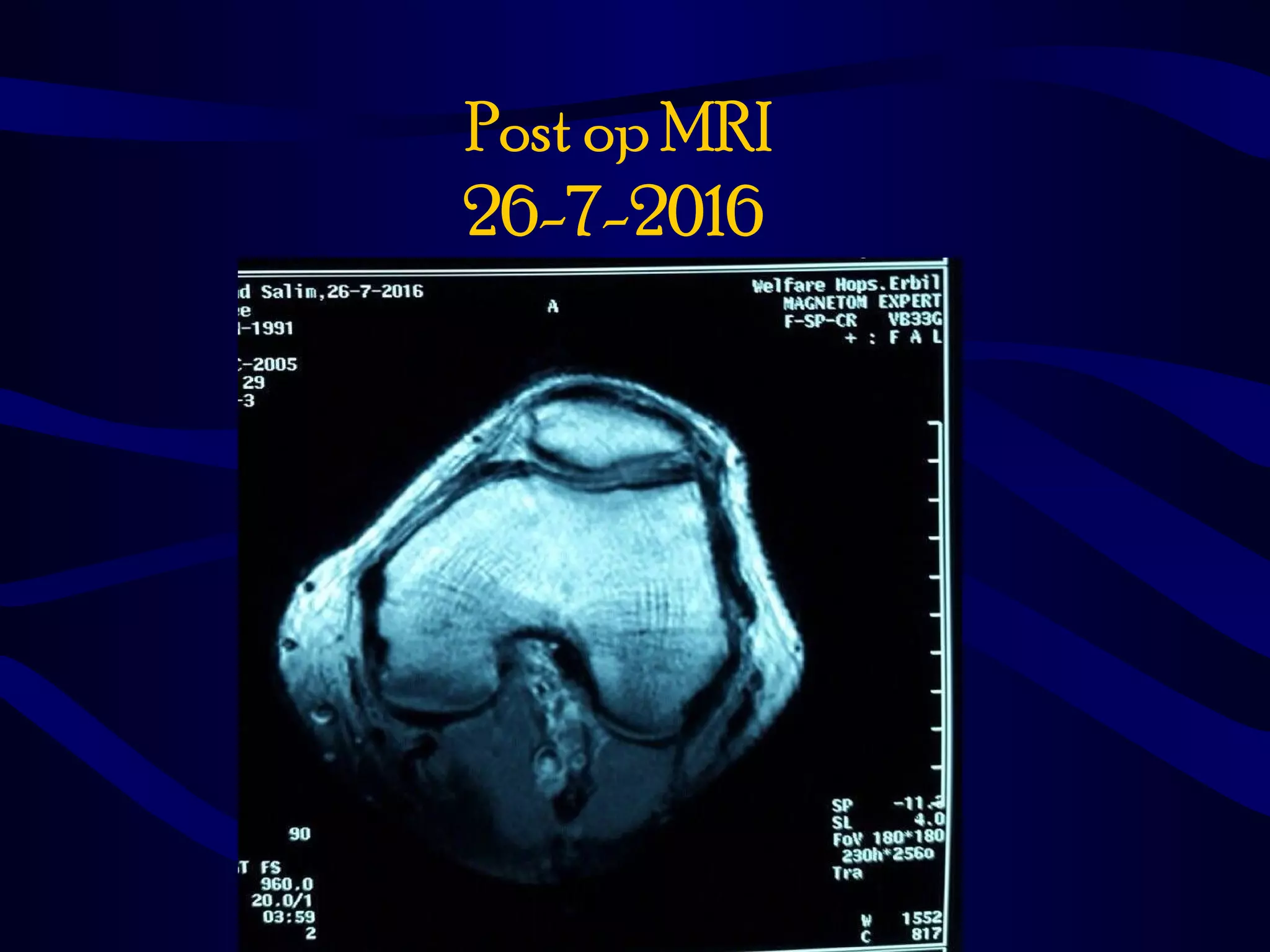 Lateral patellar compression syndrome | PPT