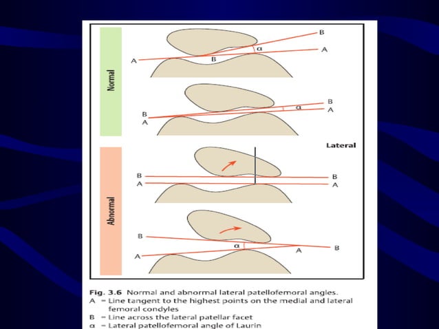 Lateral patellar compression syndrome | PPT