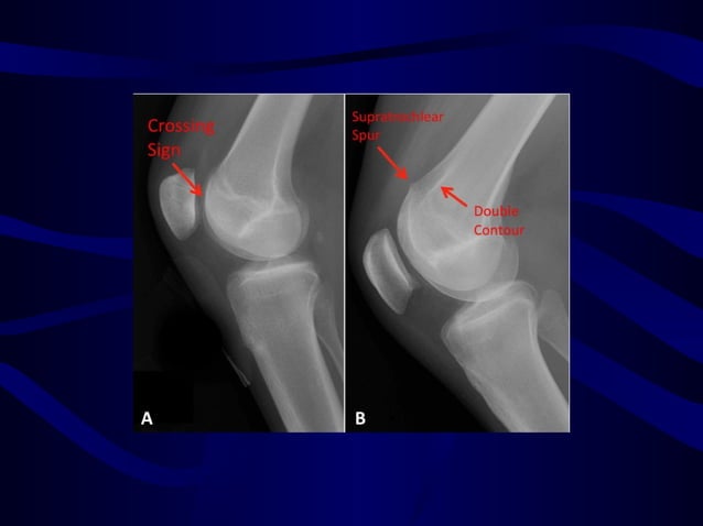 Lateral patellar compression syndrome | PPT