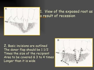 Lateral pedical graft | PPT