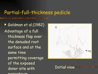 Lateral pedical graft | PPT