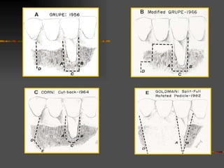 Lateral pedical graft | PPT