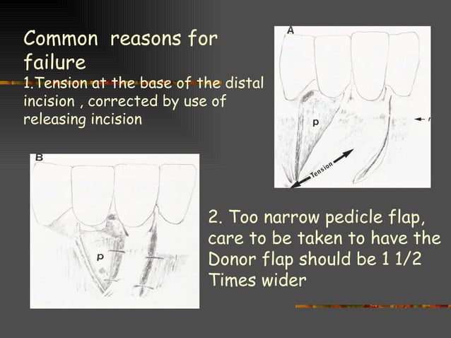 Lateral Pedical Graft